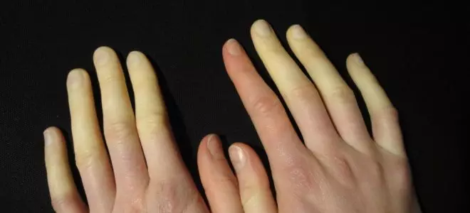 Raynaud bolest - simptomi kod žena. Bolesti i Raynaudov sindrom - uzroci, dijagnoza, liječenje, prognoza 52664_2