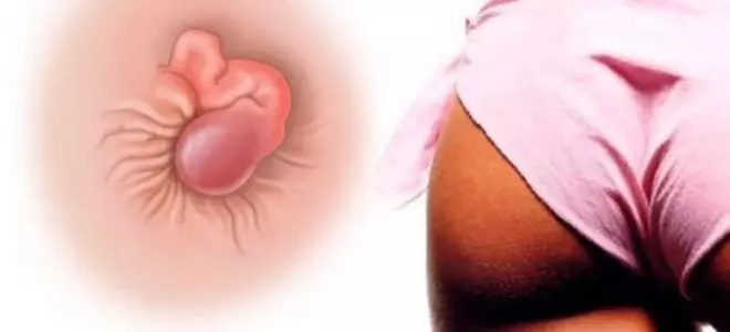 Hemorrhoids after childbirth - the causes of hemorrhoids in women, treatment with breastfeeding 5298_3