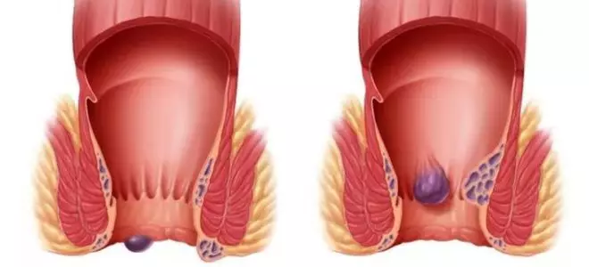 Hemorroides després del part: les causes de les hemorroides en dones, tractament amb lactància materna 5298_4