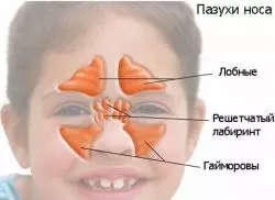 Sinusitis dalam gejala kanak-kanak