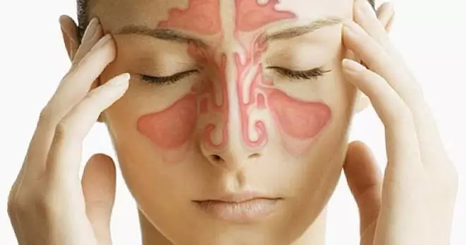 Sinusitis - Nîşan û dermankirina mezinan ji her cûre nexweşiyan