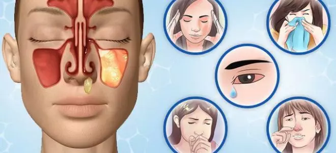 Sinusitis - nîşan û dermankirina di mezinan de. Sinusîtên qirêj û kronîk çi ye? 53193_3