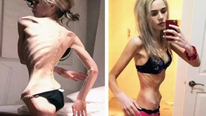 Arorexia को भयानक परिणामहरु