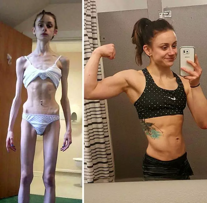 Awọn eniyan ti o ni Anorexia ko le da laisi iranlọwọ ẹnikẹta