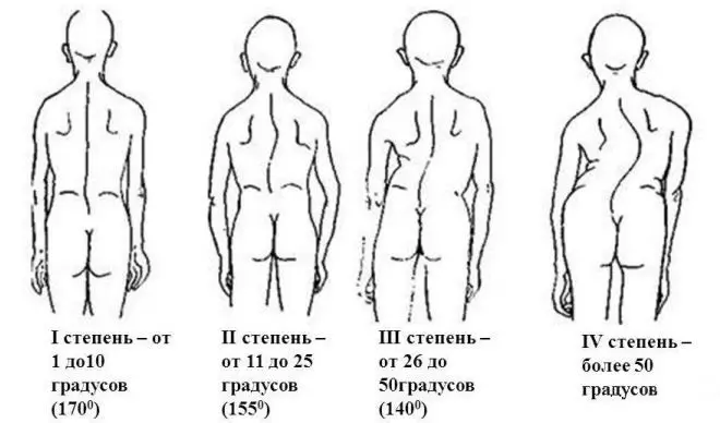 Викривлення хребта у дітей (правобічний, лівобічний сколіоз) - види. Як виправити викривлення хребта? 5745_10