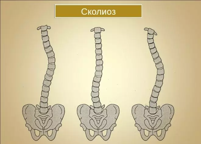 Викривлення хребта у дітей (правобічний, лівобічний сколіоз) - види. Як виправити викривлення хребта? 5745_2