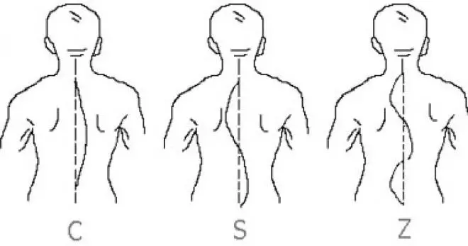 Kelengkungan tulang belakang pada kanak-kanak (kanan, scoliosis kiri) - spesies. Bagaimana untuk memperbaiki kelengkungan tulang belakang? 5745_3