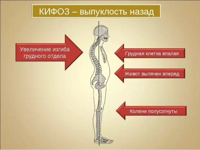 Викривлення хребта у дітей (правобічний, лівобічний сколіоз) - види. Як виправити викривлення хребта? 5745_4