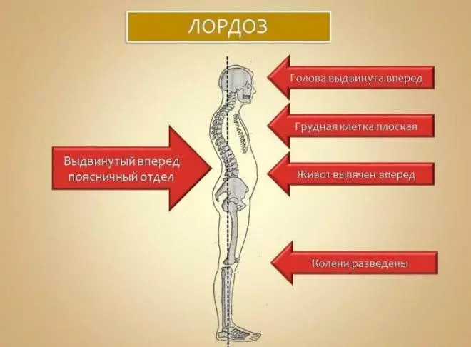 Викривлення хребта у дітей (правобічний, лівобічний сколіоз) - види. Як виправити викривлення хребта? 5745_5