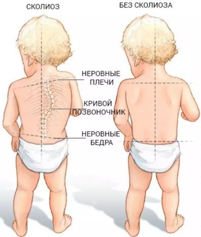 Викривлення хребта у дітей (правобічний, лівобічний сколіоз) - види. Як виправити викривлення хребта? 5745_6