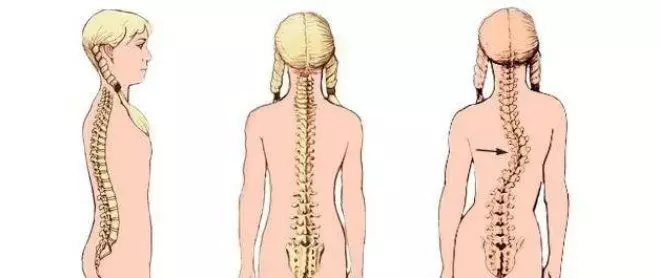 Kelengkungan tulang belakang pada kanak-kanak (kanan, scoliosis kiri) - spesies. Bagaimana untuk memperbaiki kelengkungan tulang belakang? 5745_8