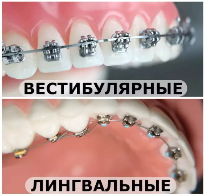 Breakers ho an'ny ankizy - karazana rafitra braces. Braces zazakely - Ahoana ny fikarakarana braces? Amin'ny firy izy ireo dia mametraka braces ho an'ny ankizy 5786_2