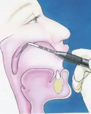 عوارض Tonsillitis مزمن