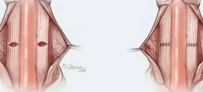 Peyronis se siekte, die kromming van die penis - ultraklank-tekens, behandeling van skokkende terapie 5895_2