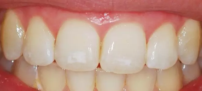 Fluorosis of the teeth - classification, cause, stage, symptoms, treatment, prevention 58969_2
