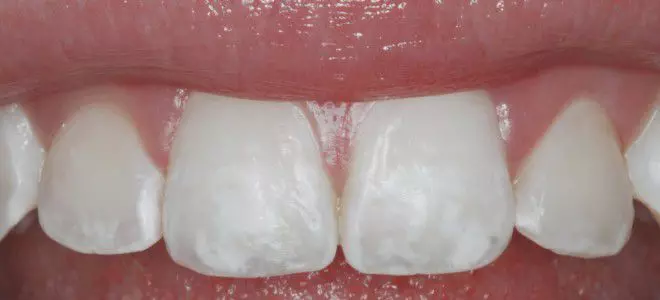Fluorosis of the teeth - classification, cause, stage, symptoms, treatment, prevention 58969_3