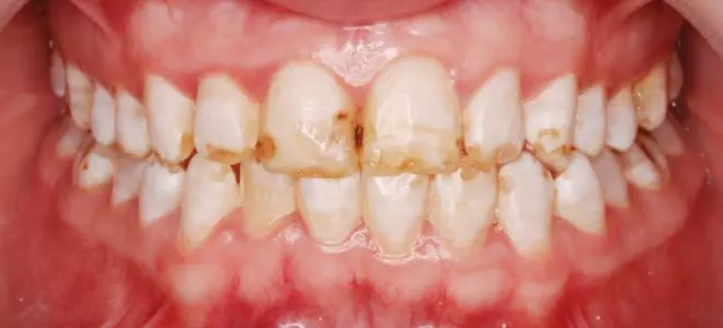 Fluorosis of the teeth - classification, cause, stage, symptoms, treatment, prevention 58969_4