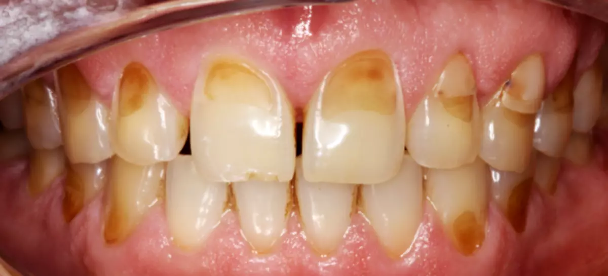 Fluorosis of the teeth - classification, cause, stage, symptoms, treatment, prevention 58969_5