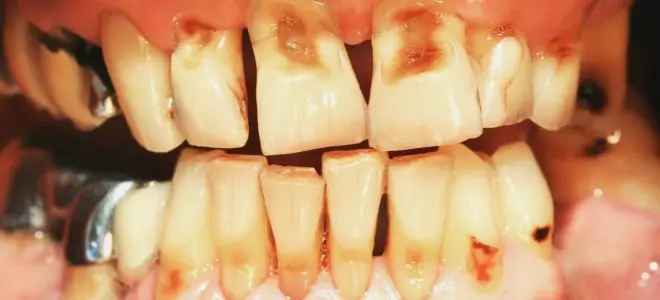 Fluorosis of the teeth - classification, cause, stage, symptoms, treatment, prevention 58969_6