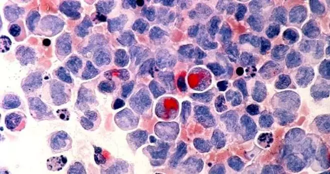 Myelodsplastic Syndrome - Faʻafefea ona e 'alofia ai Leukemia?