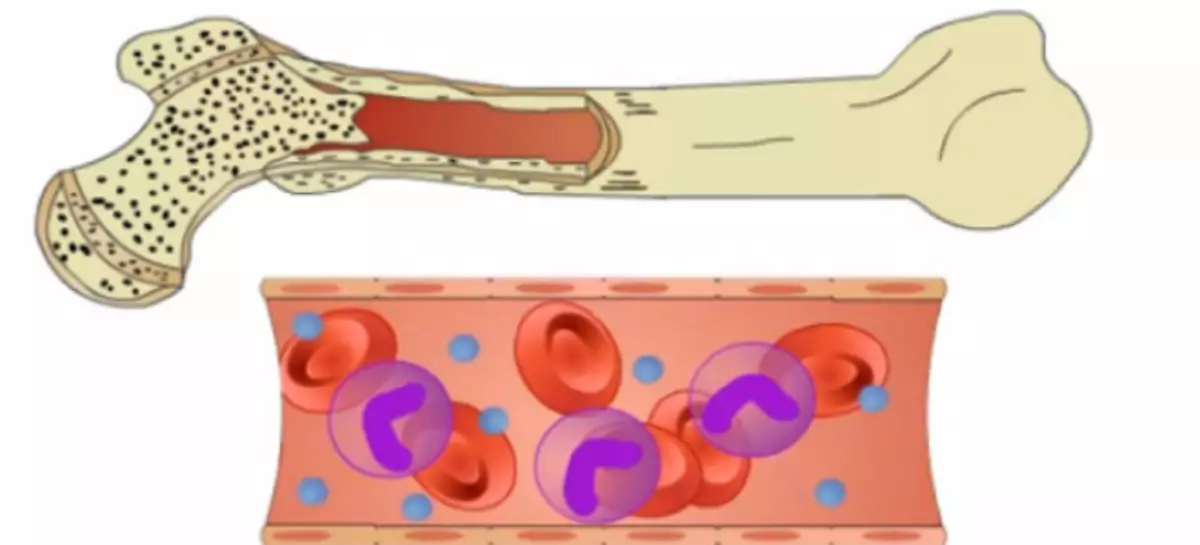 Cudurka molodsstsplastic syndrome, ogaanshaha MDS - tallooyinka caafimaad, saadaasha nolosha 59437_2