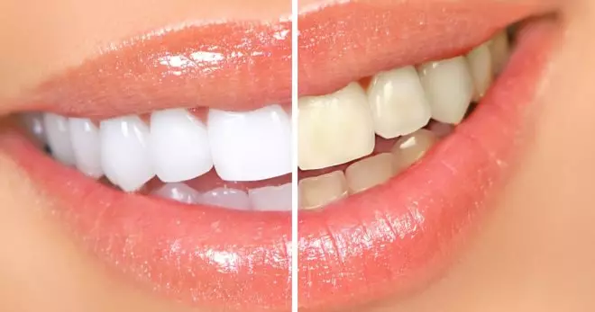 दात whitening - घरी किंवा दंत मध्ये आपले दात कसे whiten करावे?