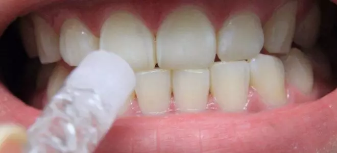 laser professionale e dei denti cosmetici sbiancanti 73058_3