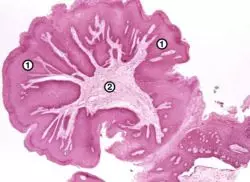 Condylomes ውስጥ ብልት