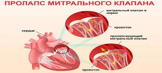 photo1 heart prolapse