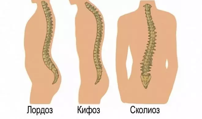 Kuburan tulang belakang (scoliosis, lordosis, kyphosis) - Cara ndandani? 9966_2