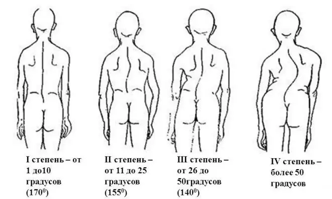 Stuburo kreivumas (skoliozė, lordosis, kyphosis) - kaip išspręsti? 9966_5